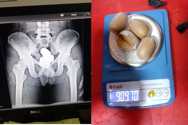 Northeast: Man Trying To Smuggle Gold Hidden Inside Body Arrested In ...